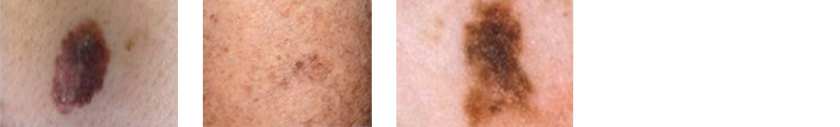 About Skin Cancer - Fremantle Skin Cancer Clinic