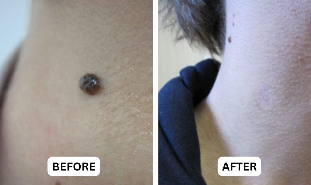 Cosmetic Mole Removal - Fremantle Skin Cancer Clinic