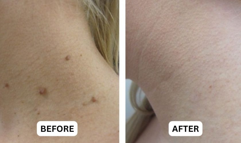 Cosmetic Mole Removal - Fremantle Skin Cancer Clinic